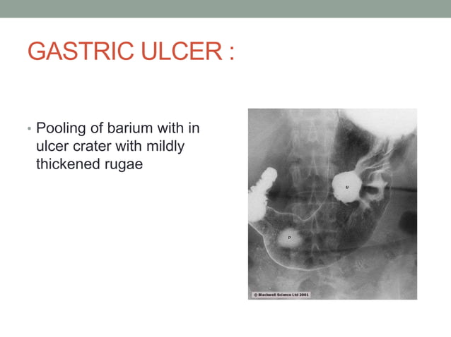 barium studies in gi pathologies | PPTX | Digestive Disorders ...