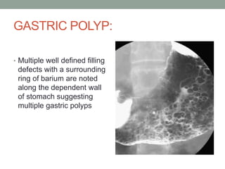 barium studies in gi pathologies | PPTX