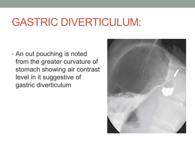 barium studies in gi pathologies | PPTX | Digestive Disorders ...