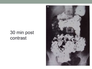 barium studies in gi pathologies | PPTX