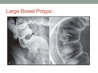 barium studies in gi pathologies | PPTX