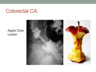 barium studies in gi pathologies | PPTX