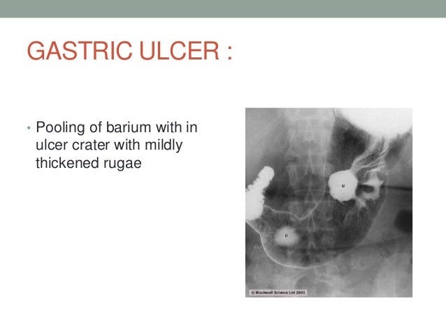 barium studies in gi pathologies