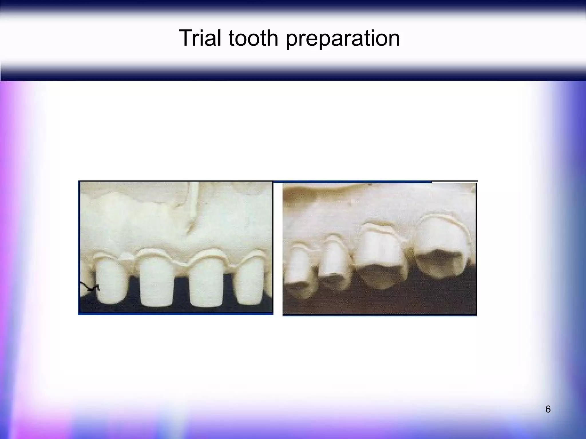 Importance of diagnostic cast in dental implant | PPT