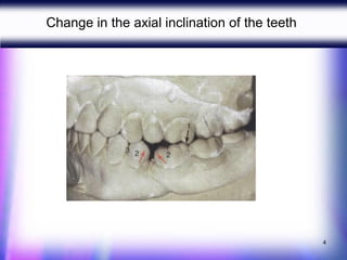 Importance of diagnostic cast in dental implant | PPT