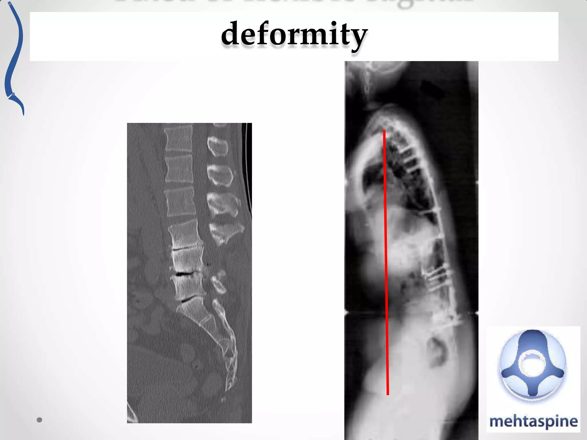 Importance of the sagittal profile in spinal deformity surgery | PPTX ...