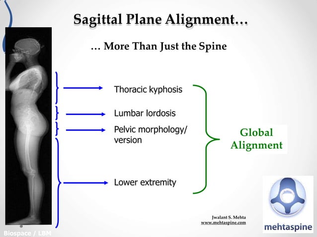 Importance of the sagittal profile in spinal deformity surgery | PPTX ...