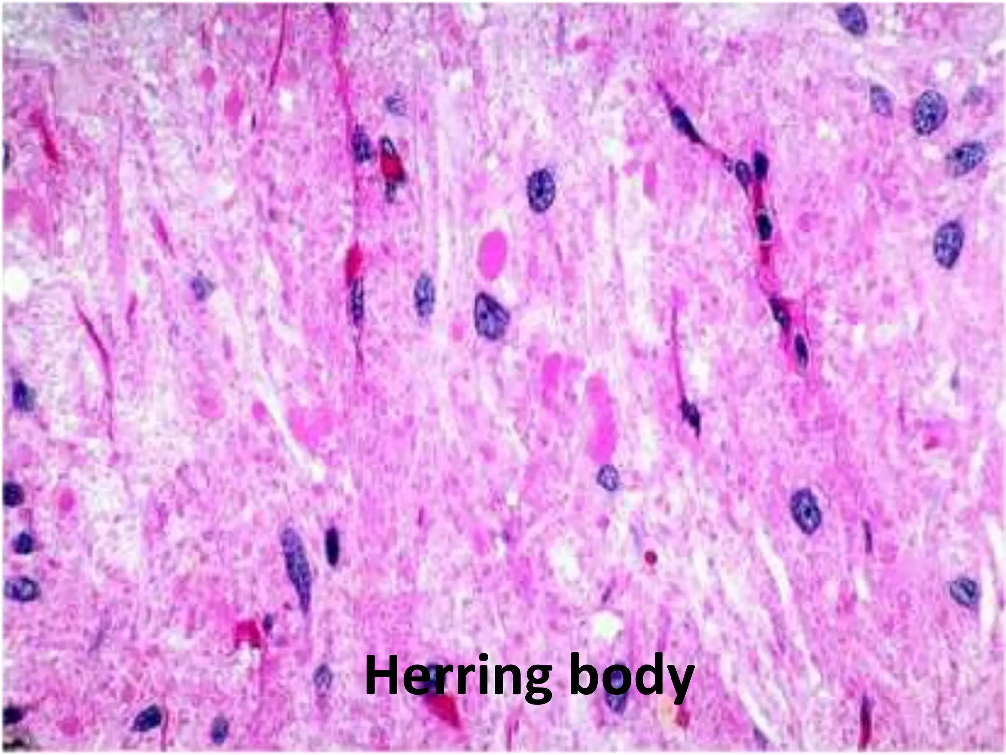 Important bodies in pathology | PPTX