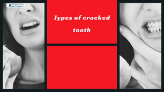 Important Things to Know About Cracked Tooth Syndrome | PPTX