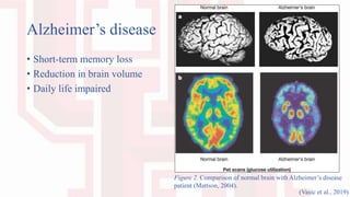 Alzheimer's Research Review Paper | PPT