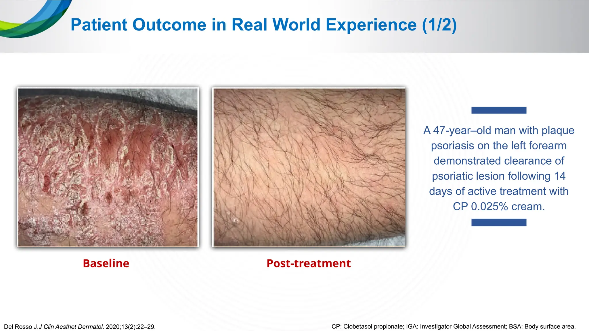 'Impoyz Cream Final Slide Deck'.- clobetasol | PPTX