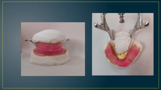 imppression techniques for edentulous jaws | PPTX