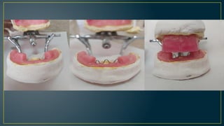imppression techniques for edentulous jaws | PPTX