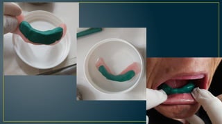 imppression techniques for edentulous jaws | PPTX
