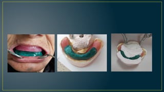 imppression techniques for edentulous jaws | PPTX
