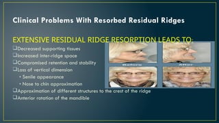 imppression techniques for edentulous jaws | PPTX