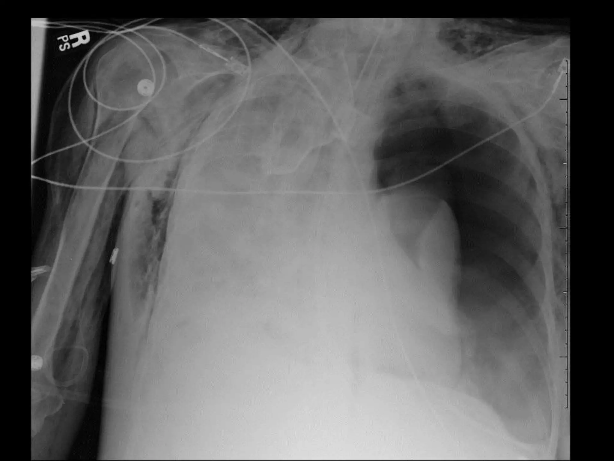 Lines, Tubes and ICU CXR - Smith | PPTX