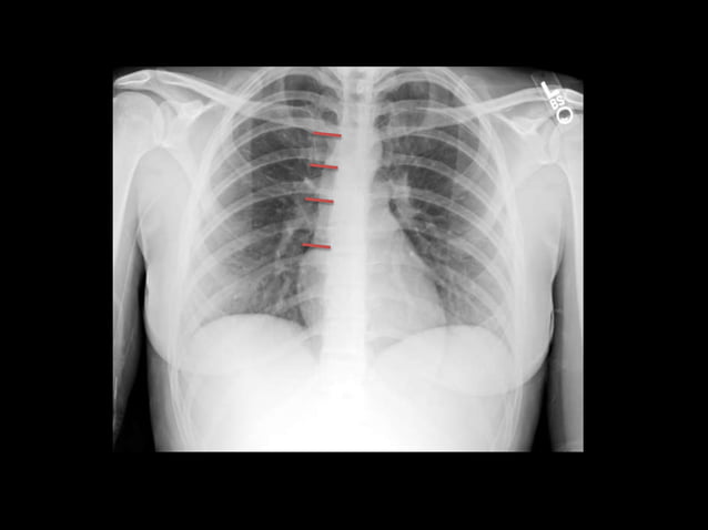 Lines, Tubes and ICU CXR - Smith | PPTX