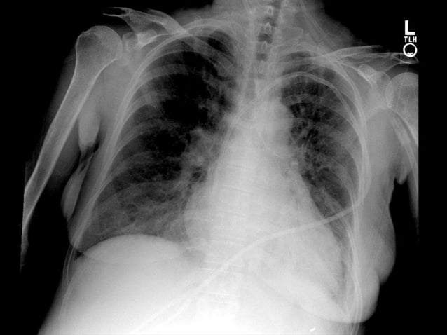 Lines, Tubes and ICU CXR - Smith | PPTX