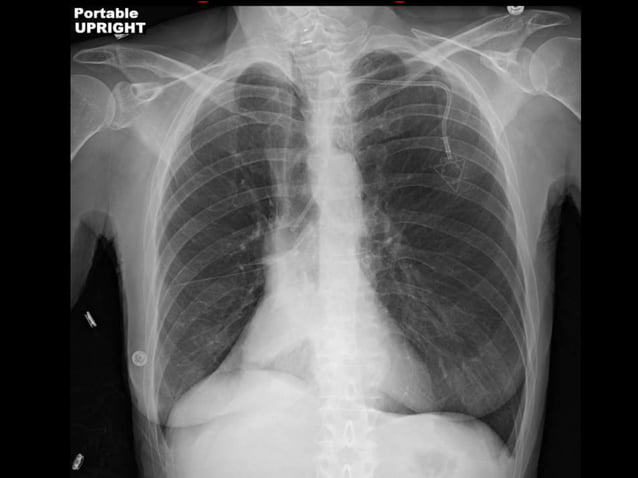 Lines, Tubes and ICU CXR - Smith | PPTX