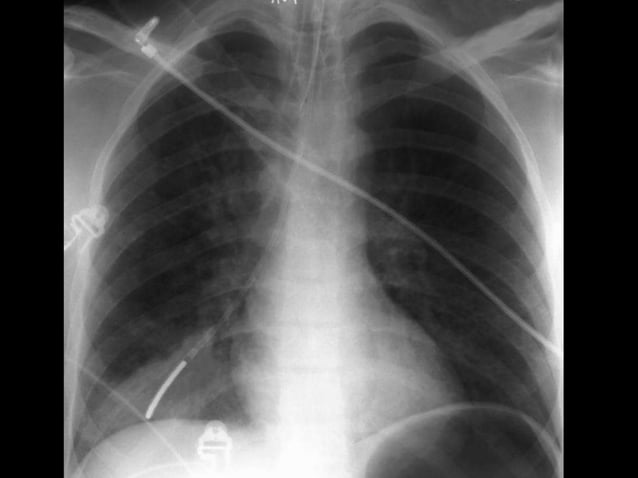 Lines, Tubes and ICU CXR - Smith | PPTX