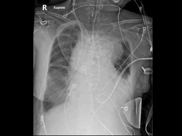 Lines, Tubes and ICU CXR - Smith | PPT