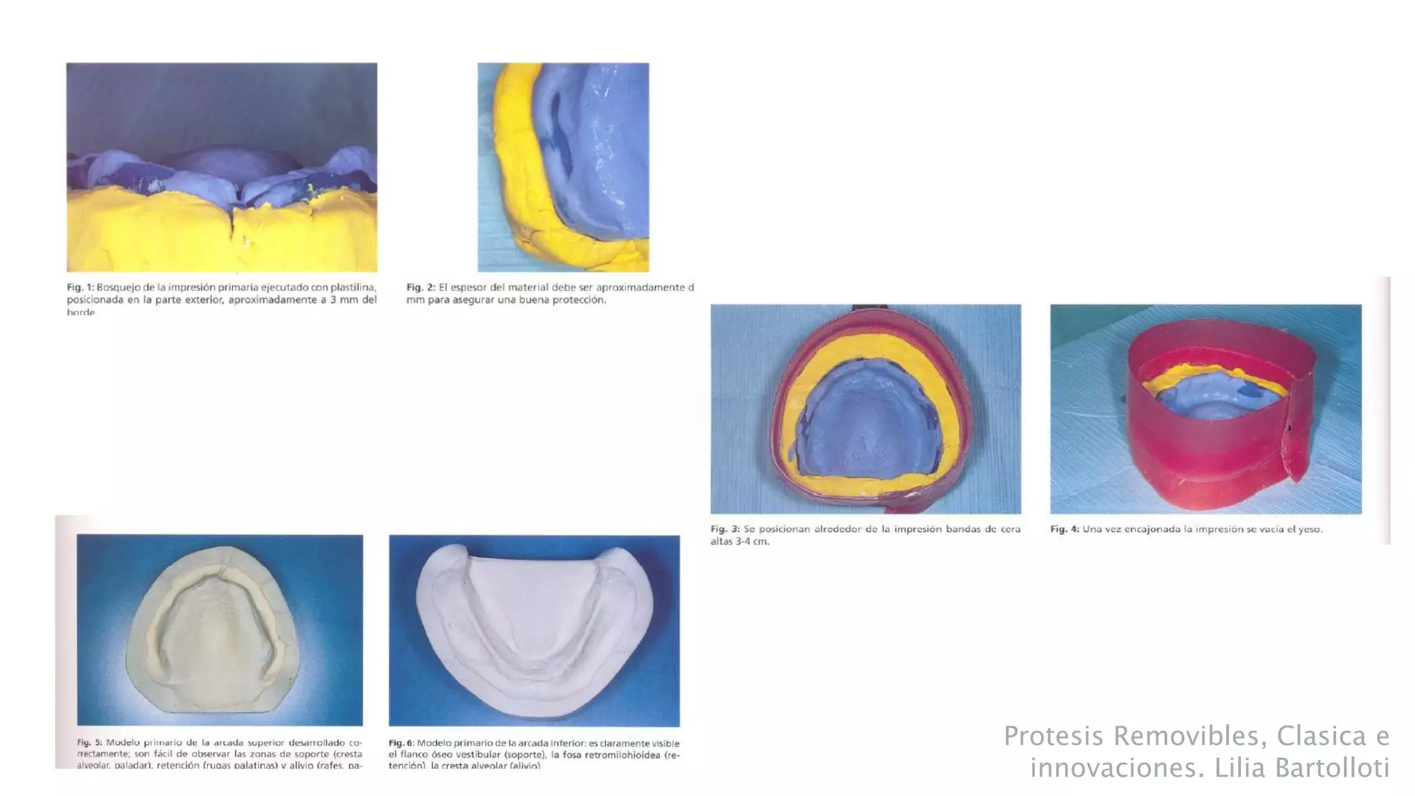 Impresiones y modelos de diagnostico PPR | PPTX