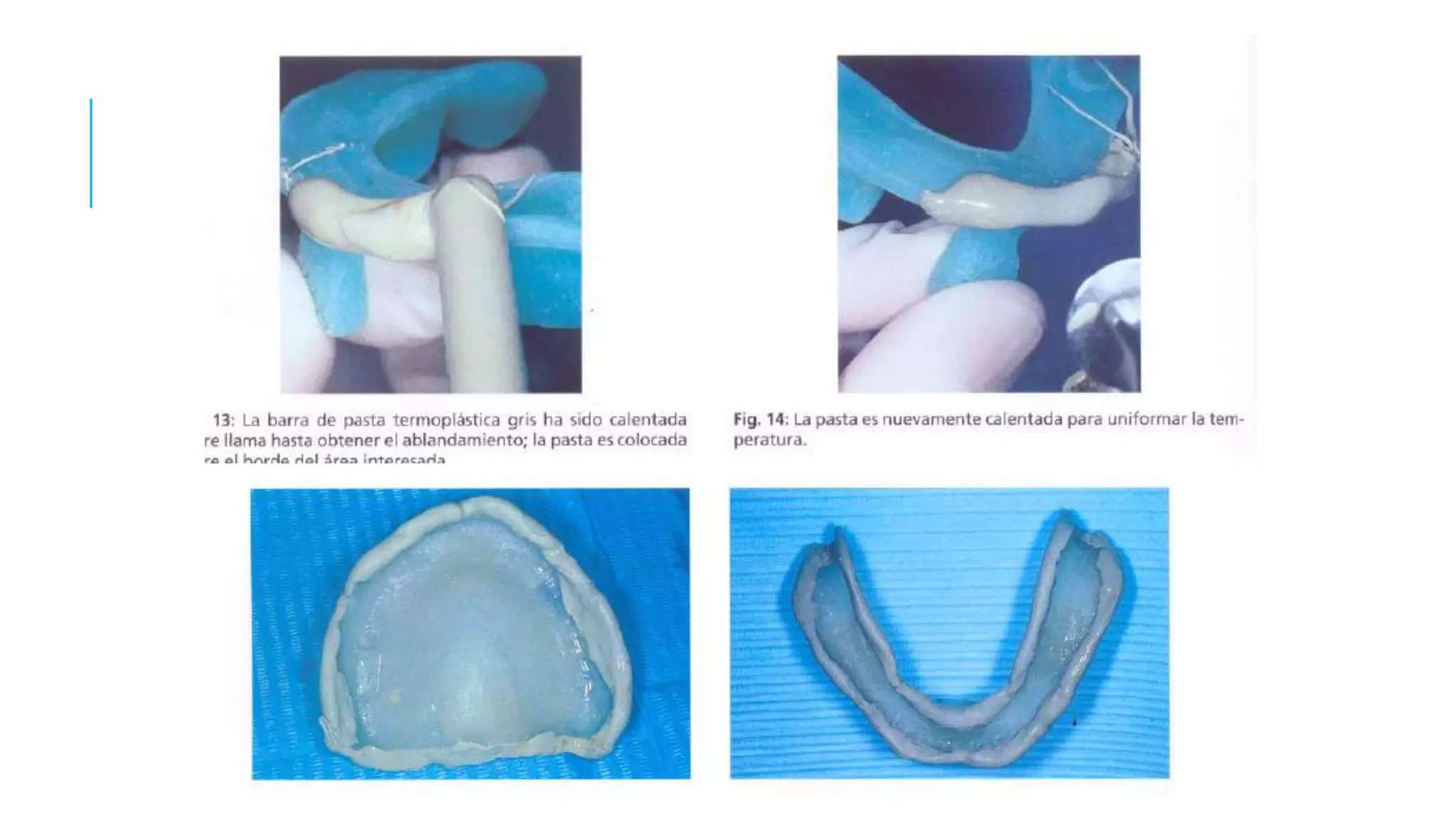 Impresiones y modelos de diagnostico PPR | PPTX