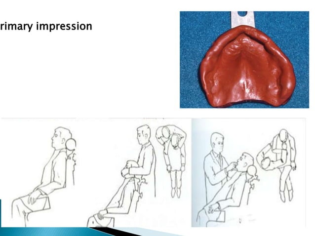 K-prosthodontic-lec2-Impression for complete denture | PPTX | Dental ...