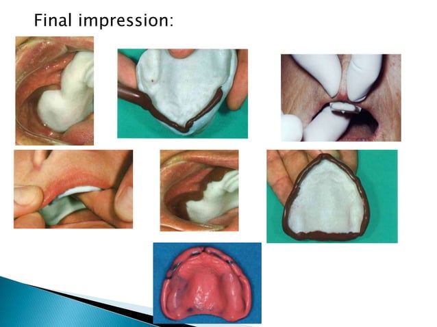 K-prosthodontic-lec2-Impression for complete denture | PPTX | Dental ...