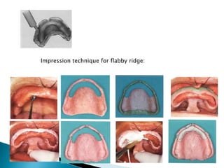 K-prosthodontic-lec2-Impression for complete denture | PPT