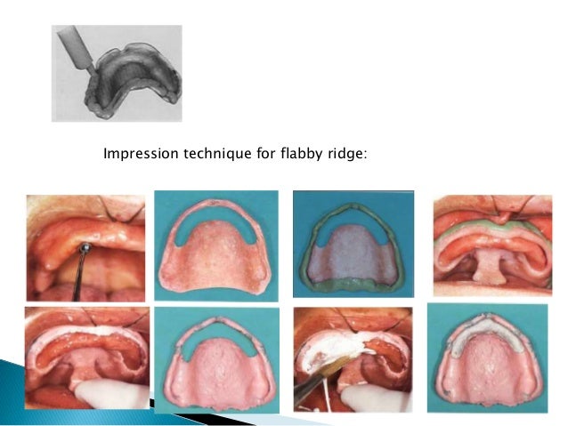 K-prosthodontic-lec2-Impression for complete denture
