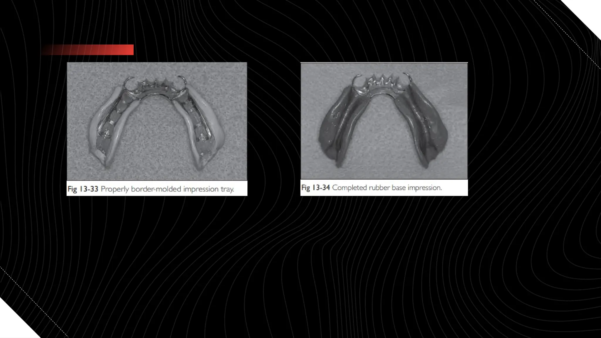 impression in distal extension rpd.pptx presentation seminar | PPT