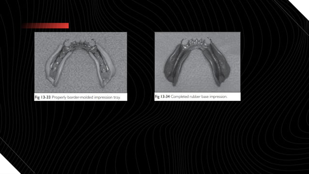 impression in distal extension rpd.pptx presentation seminar | PPT