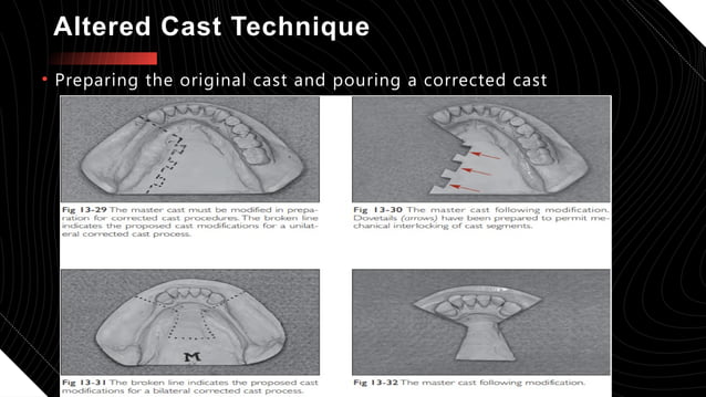 impression in distal extension rpd.pptx presentation seminar | PPT