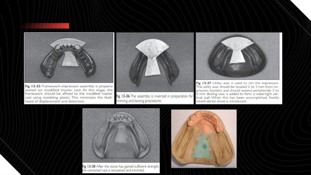 impression in distal extension rpd.pptx presentation seminar | PPT