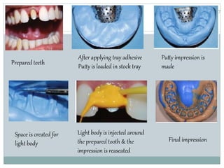 IMPRESSION MAKING IN FIXED PARTIAL DENTURE.pptx