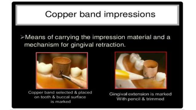 Impression materials | PPT