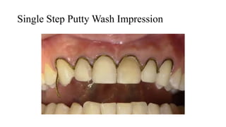 Impression materials and techniques in fpd part 2 | PPTX