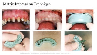 Impression materials and techniques in fpd part 2 | PPTX