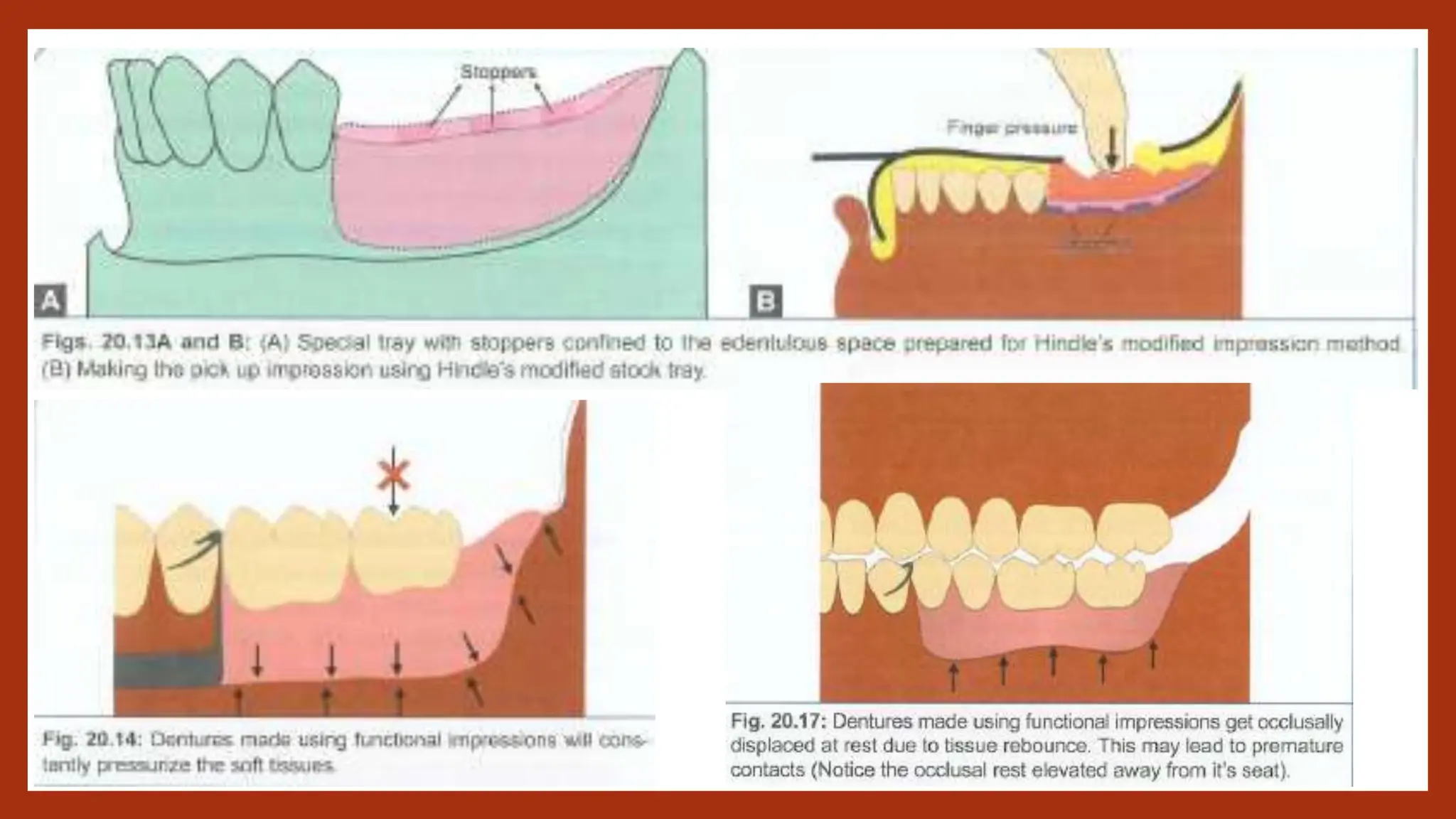 Impression procedure for distal extension RPD.pptx