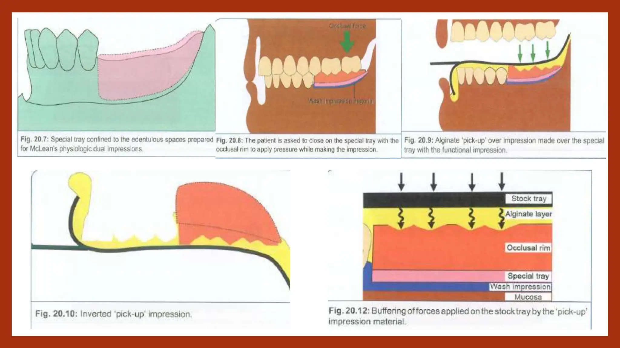 Impression procedure for distal extension RPD.pptx