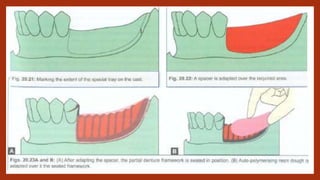 Impression procedure for distal extension RPD.pptx