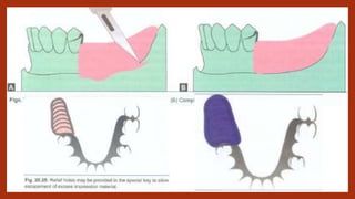Impression procedure for distal extension RPD.pptx