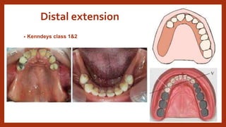 Impression procedure for distal extension RPD.pptx