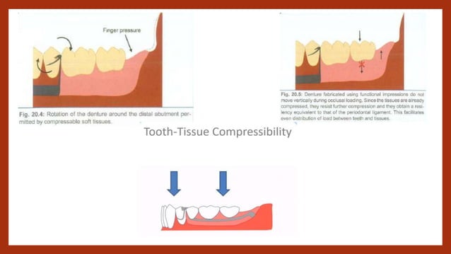 Impression procedure for distal extension RPD.pptx | Oral care ...