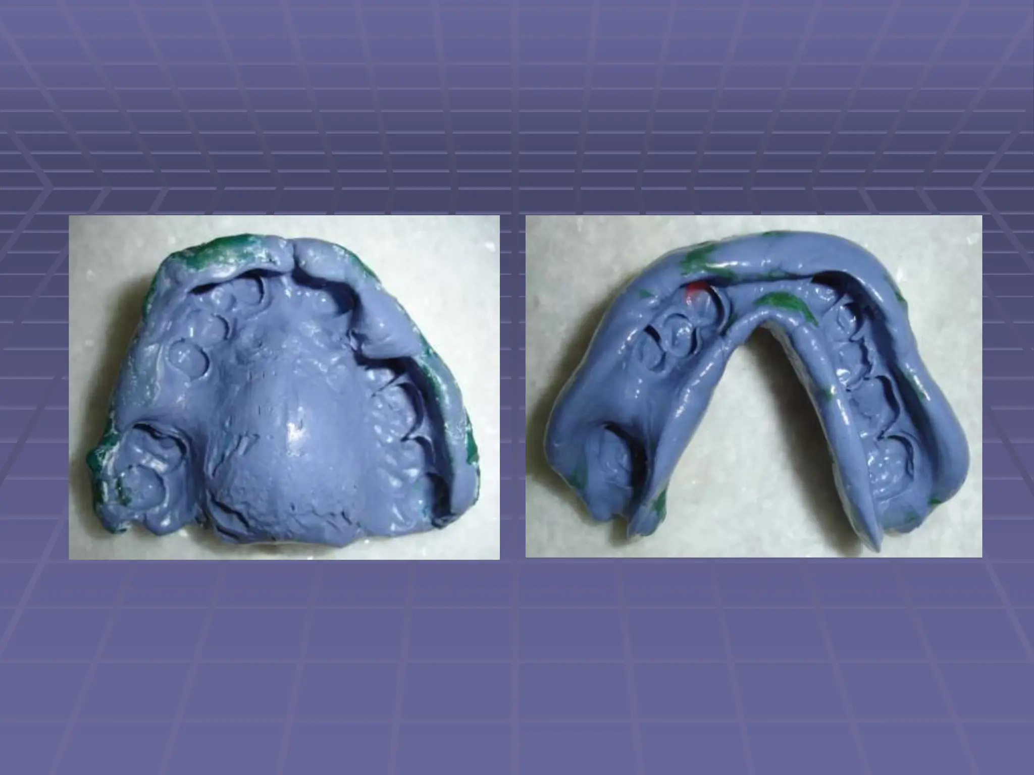 Impression Procedure for RPD’s- mandy.ppt