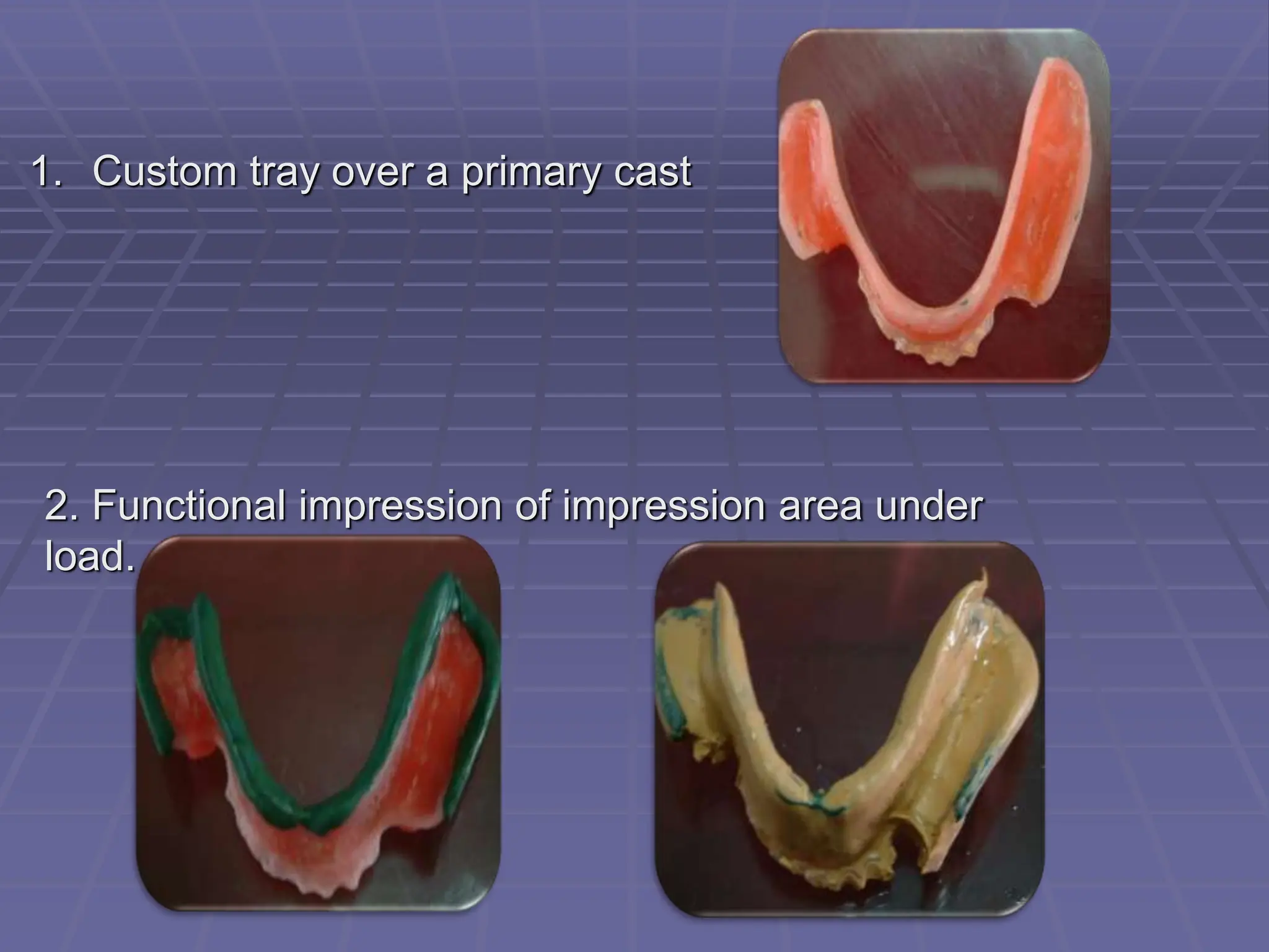 Impression Procedure for RPD’s- mandy.ppt