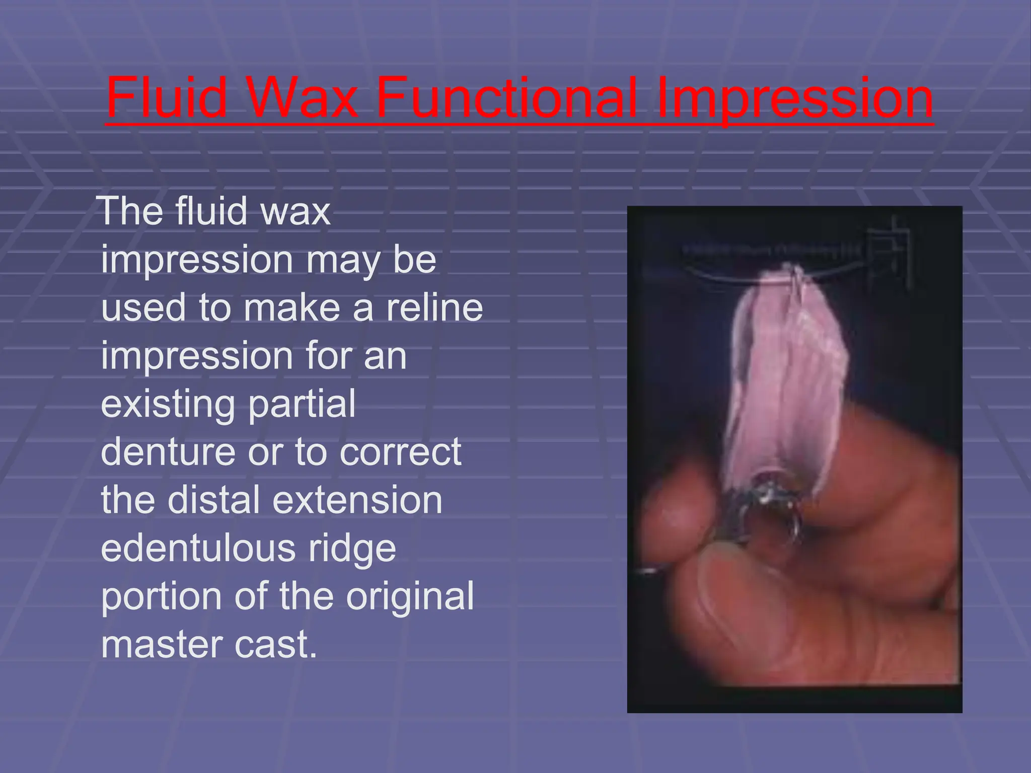 Impression Procedure for RPD’s- mandy.ppt
