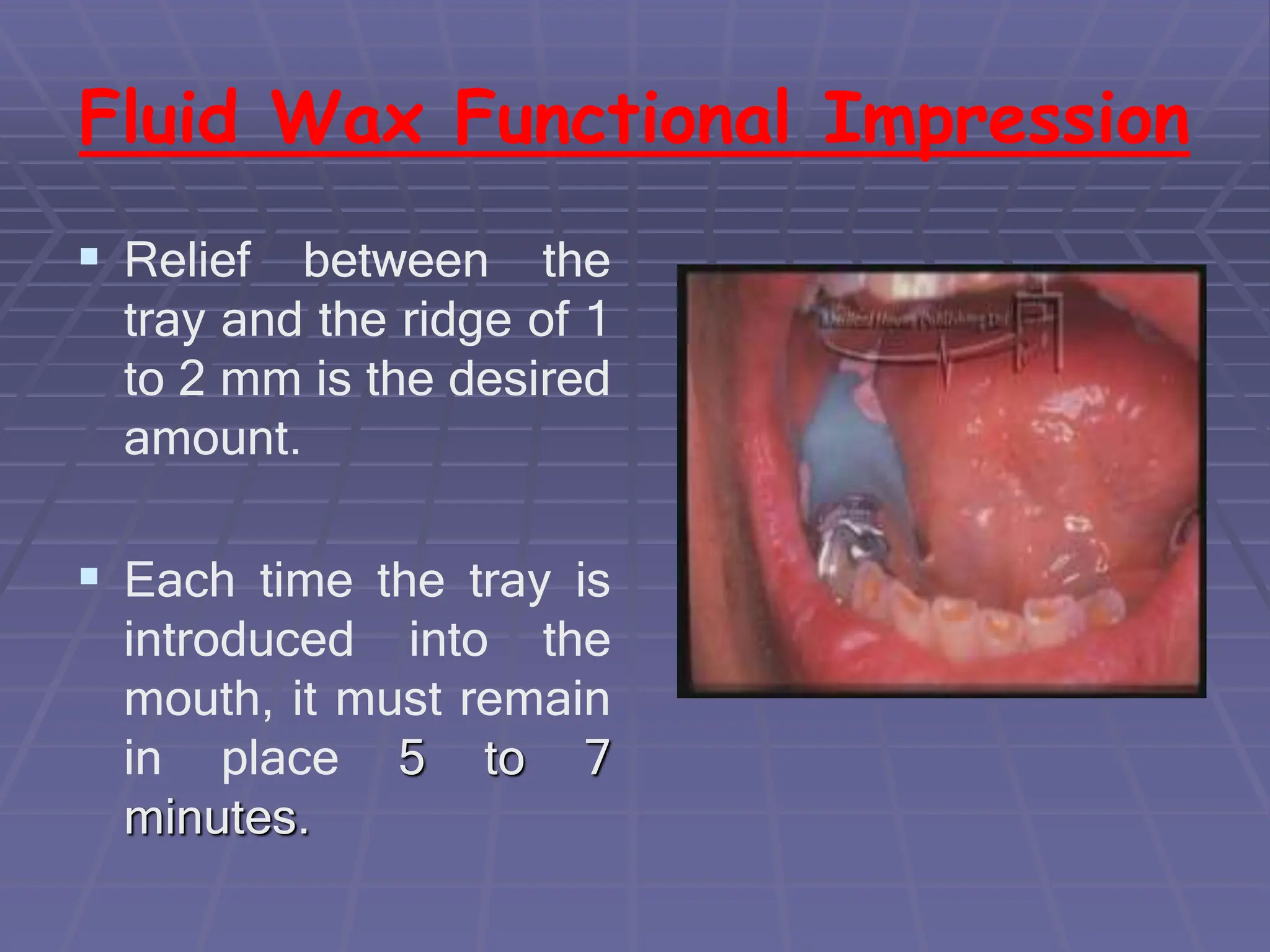 Impression Procedure for RPD’s- mandy.ppt